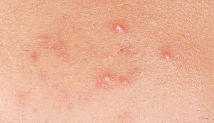 Know the 6 Types Of Pimples and Their Treatments | Seed in the Pimple ...