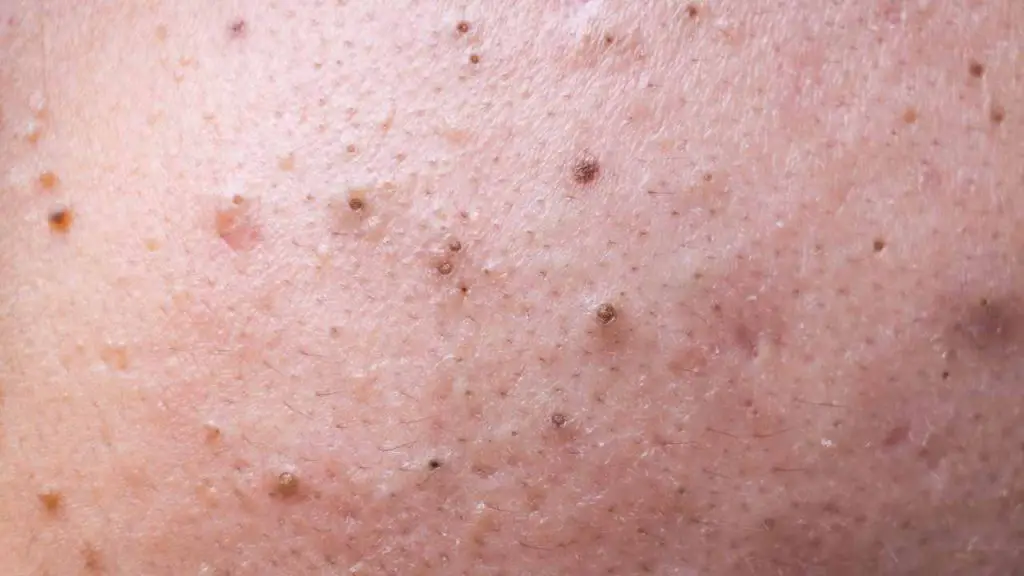 Know the 6 Types Of Pimples and Their Treatments | Seed in the Pimple ...