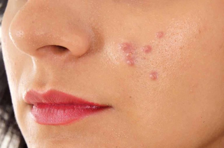 Know the 6 Types Of Pimples and Their Treatments | Seed in the Pimple ...
